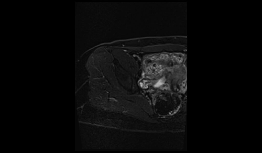 appendix MRI T2 tse fat sat axial images