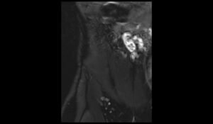 appendix MRI T2 tse fat sat coronal images