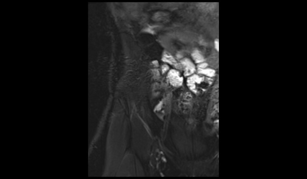 appendix MRI T2 tse fat sat coronal images