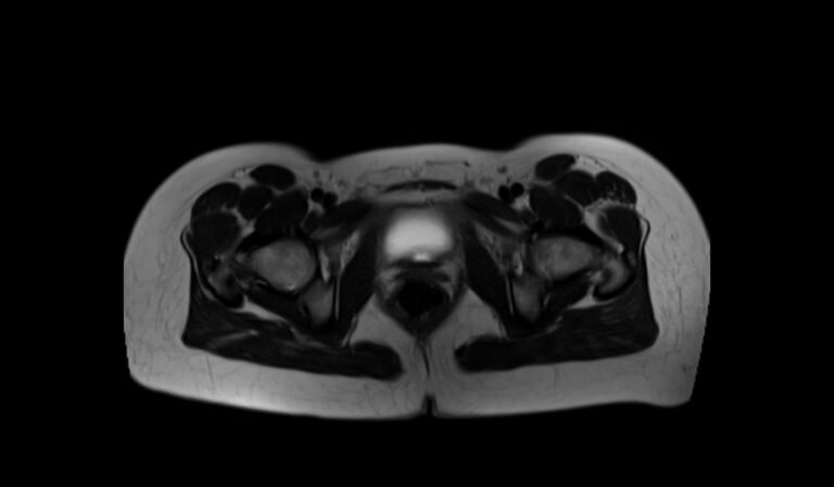 appendix MRI HASTE axial image