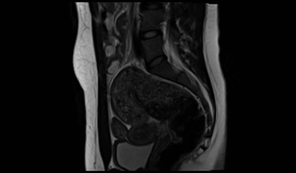 appendix MRI T2 tse sagittal images
