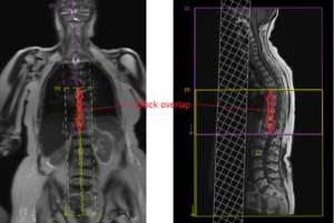 MRI whole spine | MRI whole spine protocol and planning
