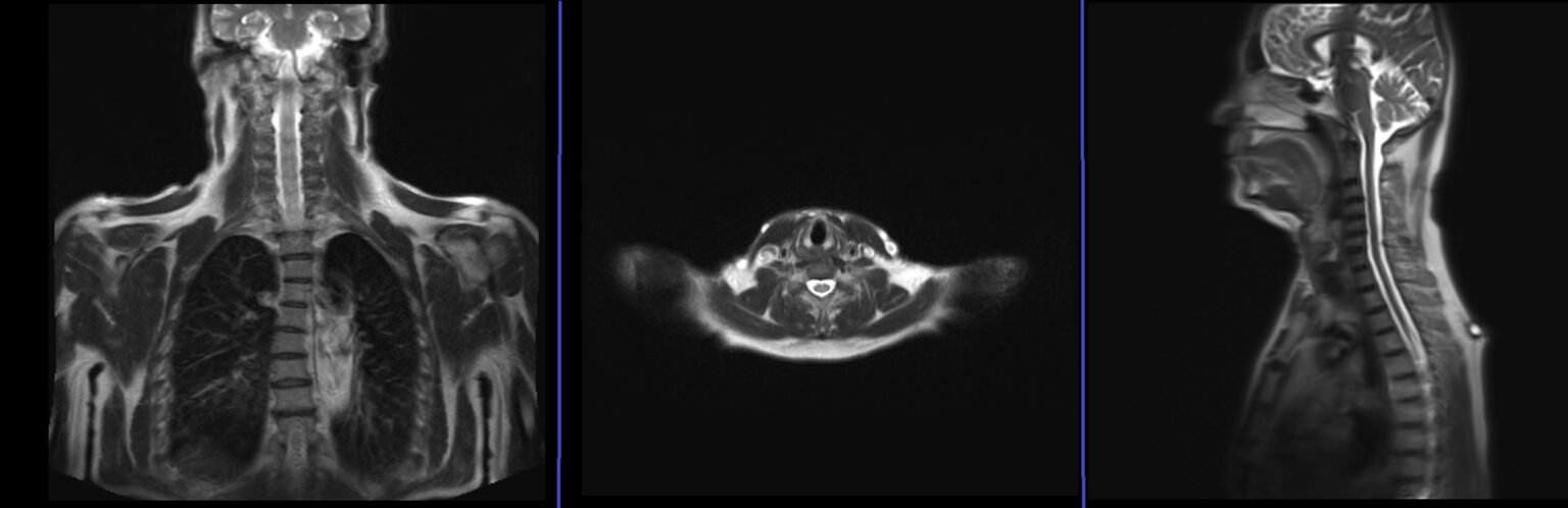 MRI whole spine | MRI whole spine protocol and planning