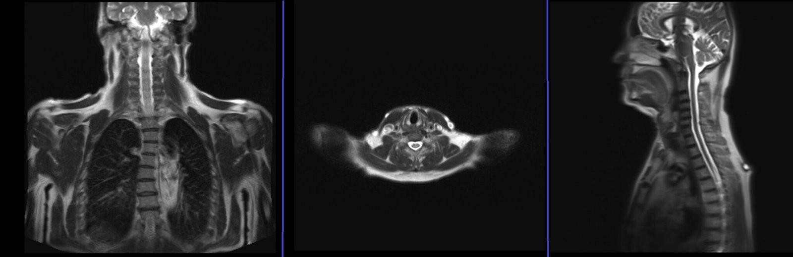MRI whole spine | MRI whole spine protocol and planning