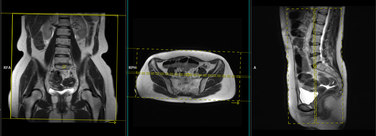 Endometriosis MRI | Endometriosis MRI Protocol and Planning