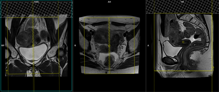 Endometriosis MRI | Endometriosis MRI Protocol and Planning