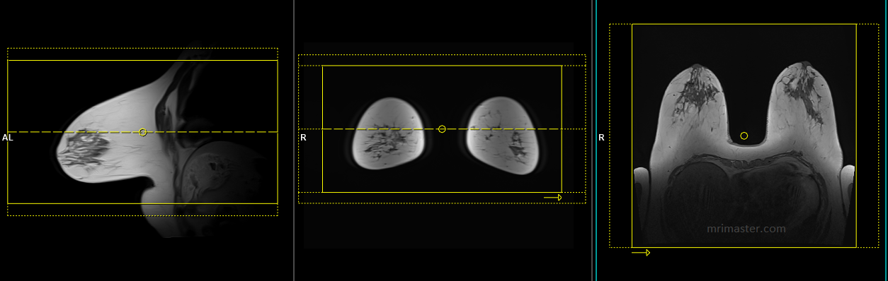 MRI Breast Scan Protocols and Planning | Indications for MRI Breast