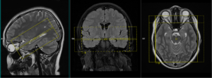 MRI Brain Epilepsy Protocol and Planning | Indications for MRI Brain ...