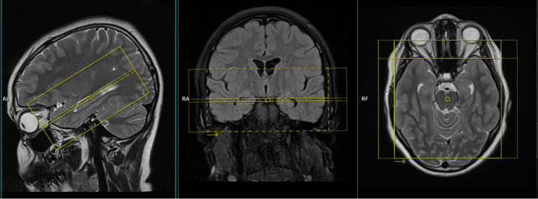 MRI Brain Epilepsy Protocol and Planning | Indications for MRI Brain ...