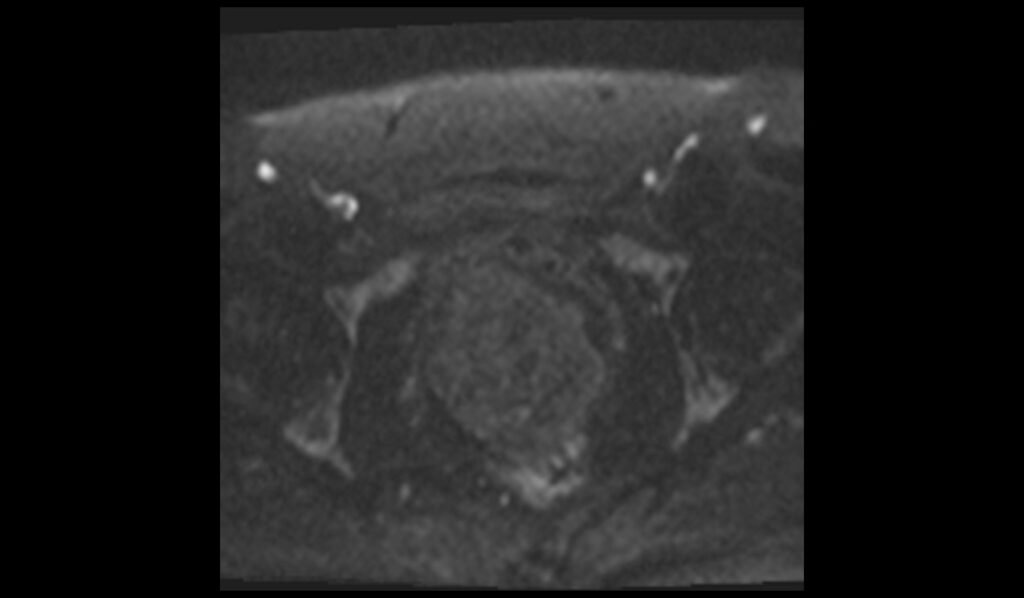 MRI gynae fibroids EPI DWI axial images