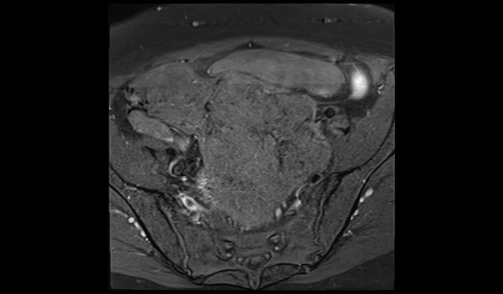 MRI gynae fibroids T1 fat sat axial images