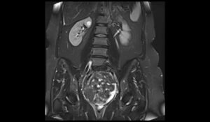 MRI gynae fibroids T2 STIR coronal images