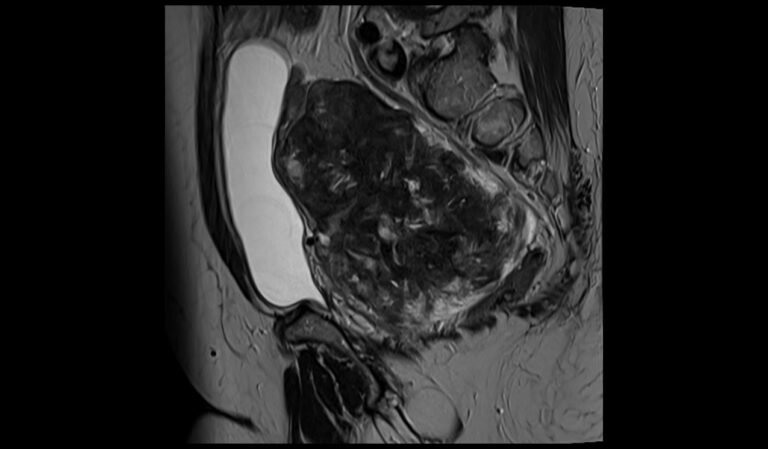 MRI gynae fibroids T2 TSE sagittal images