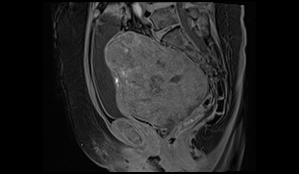MRI gynae fibroids T1 dynamic post contrast images