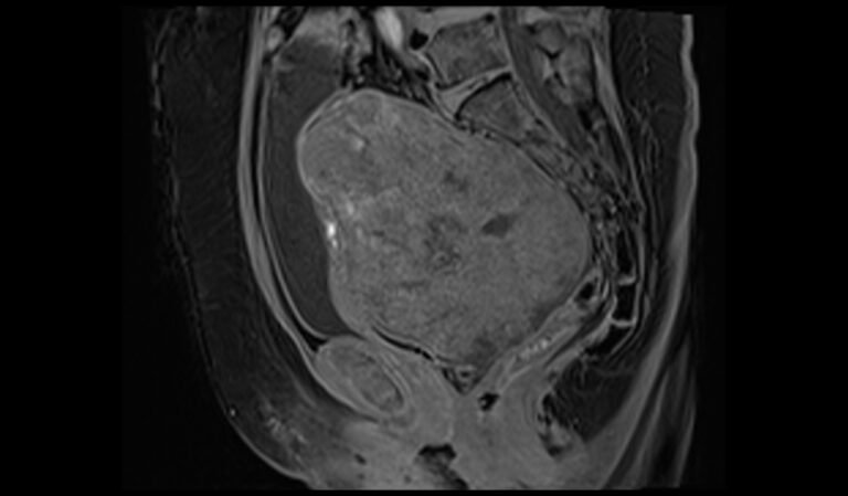 MRI gynae fibroids T1 dynamic post contrast images
