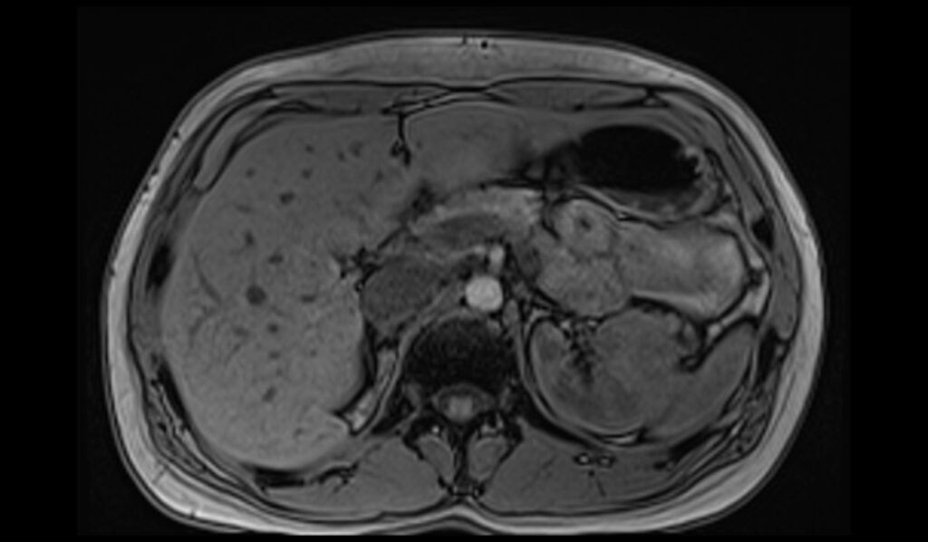 PLAN MRI KIDNEYS T1 VIBE OPP AXIAL - mrimaster
