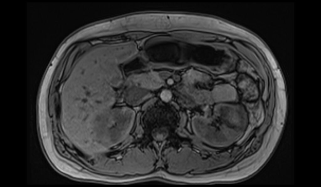 PLAN MRI KIDNEYS T1 VIBE OPP AXIAL - mrimaster