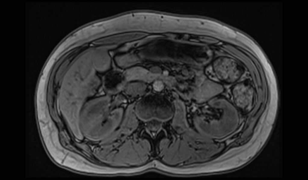 PLAN MRI KIDNEYS T1 VIBE OPP AXIAL - mrimaster