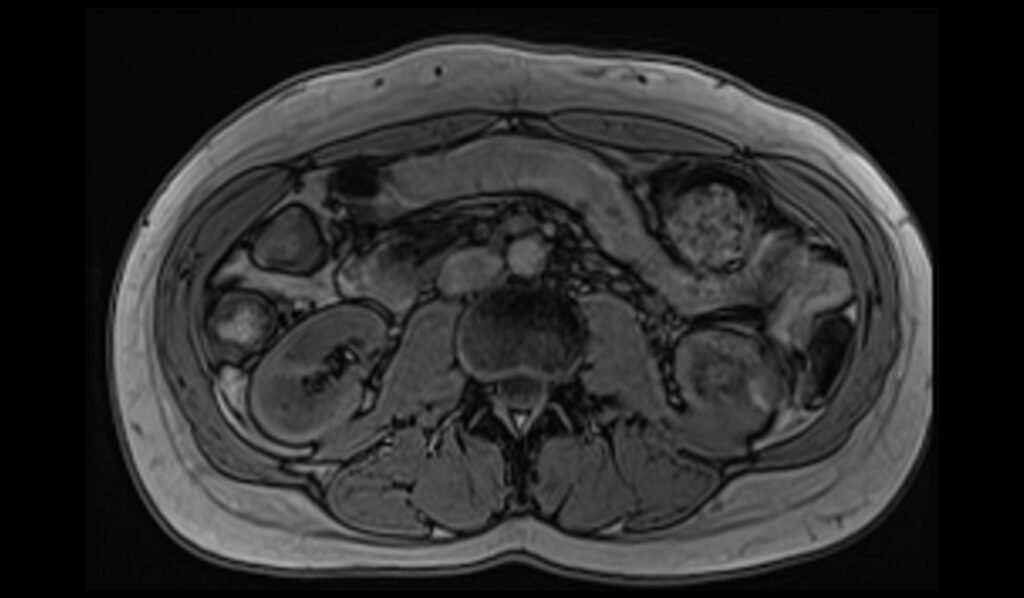 PLAN MRI KIDNEYS T1 VIBE OPP AXIAL - mrimaster