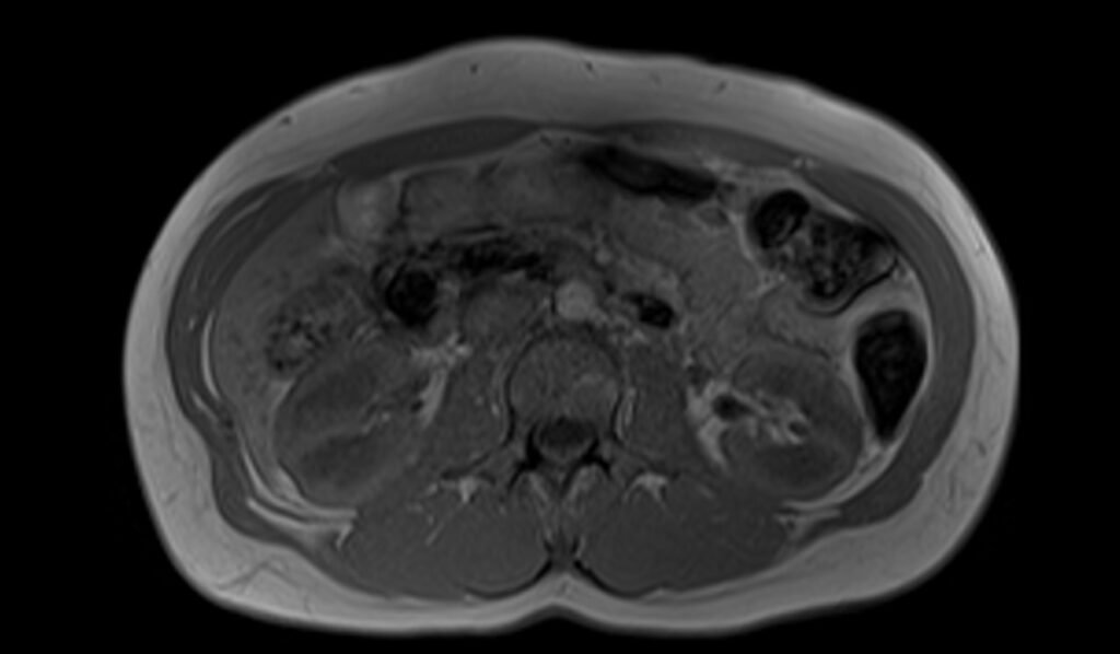 PLAN MRI KIDNEYS T1 VIBE IN OPP AXIAL. - mrimaster