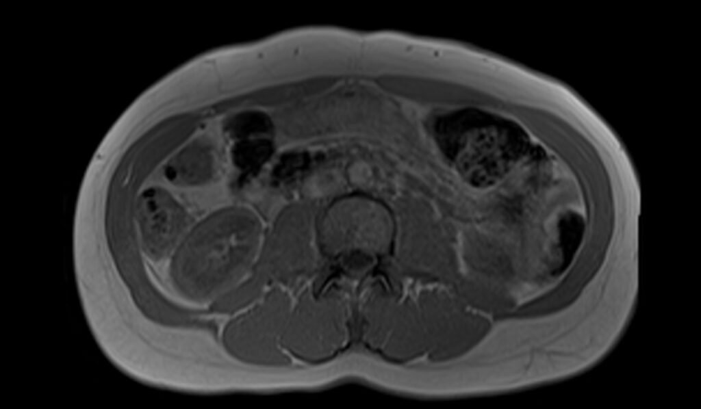 PLAN MRI KIDNEYS T1 VIBE IN OPP AXIAL. - mrimaster