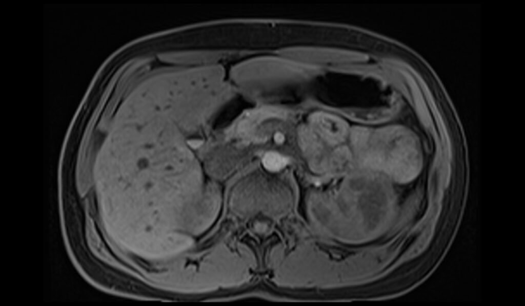 MRI kidneys In-phase and out-of-phase images