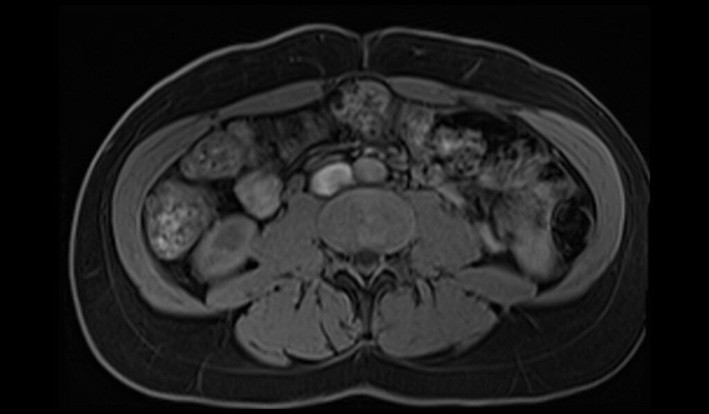 MRI kidneys In-phase and out-of-phase images