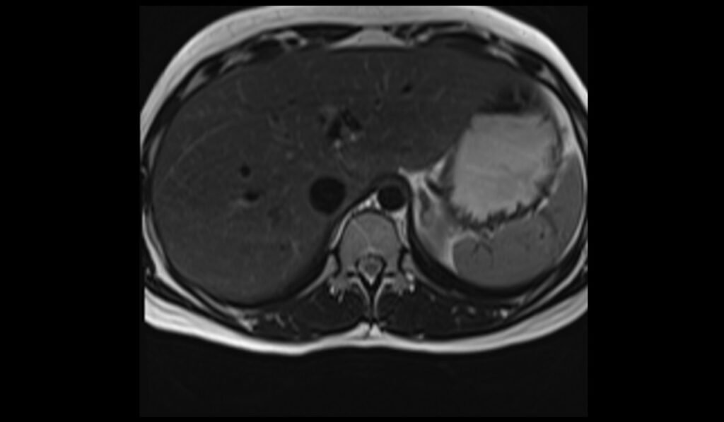 MRI kidneys T2 tse axial images