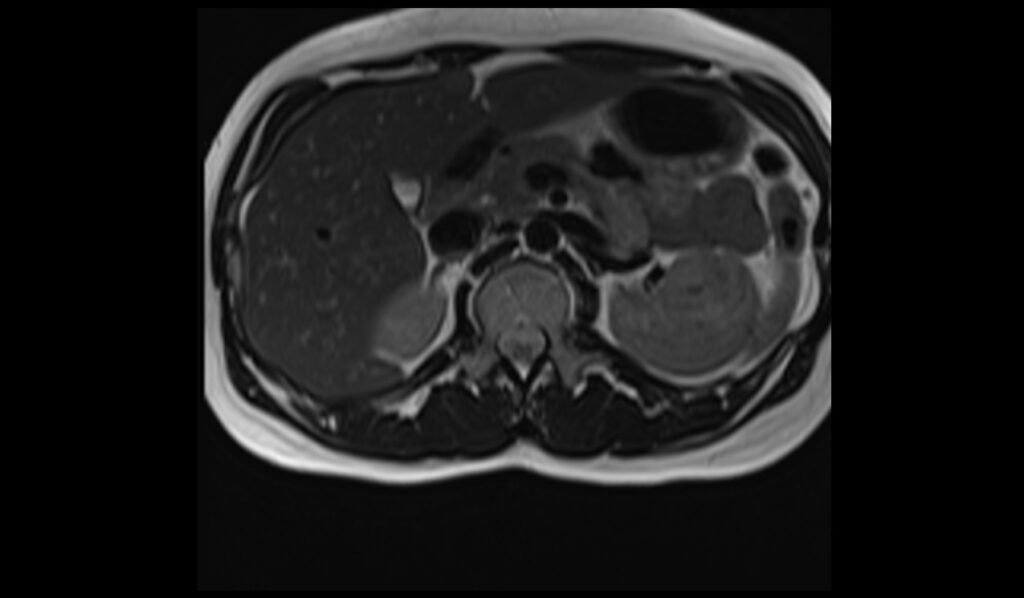 MRI kidneys T2 tse axial images