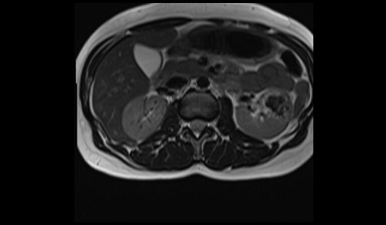 MRI kidneys T2 tse axial images