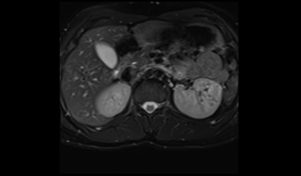 MRI kidneys T2 tse fat sat axial images