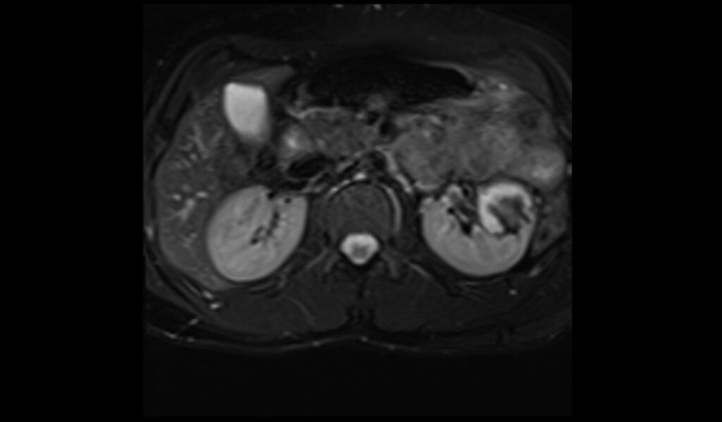 MRI kidneys T2 tse fat sat axial images