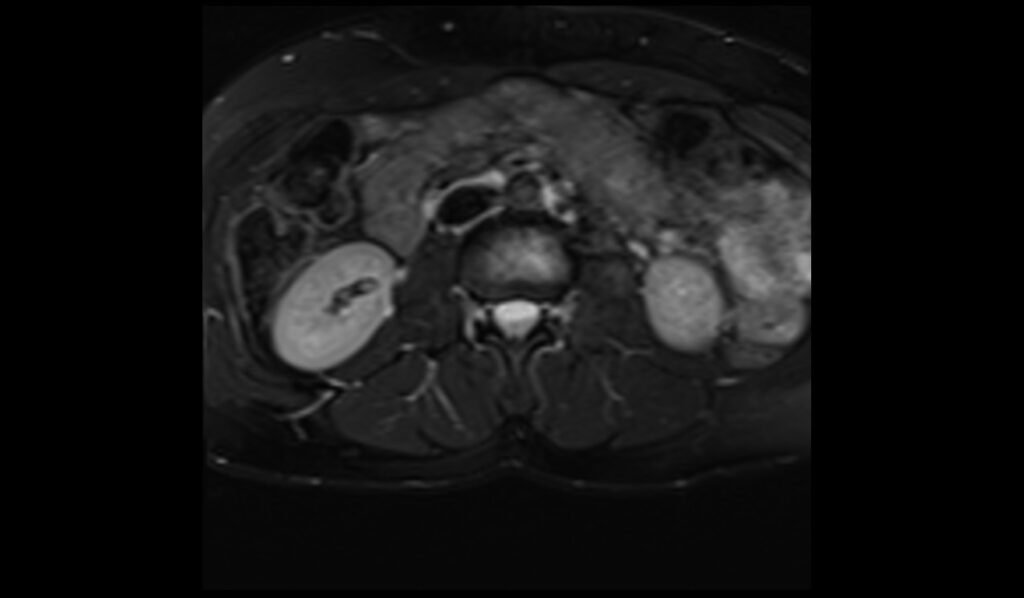 MRI kidneys T2 tse fat sat axial images