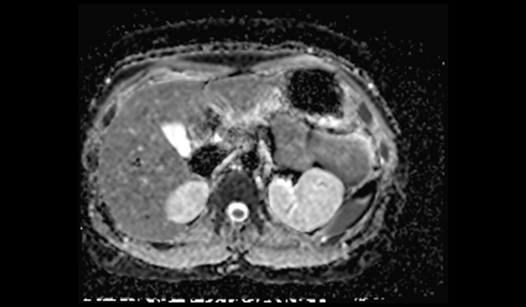 MRI kidneys DWI axial images
