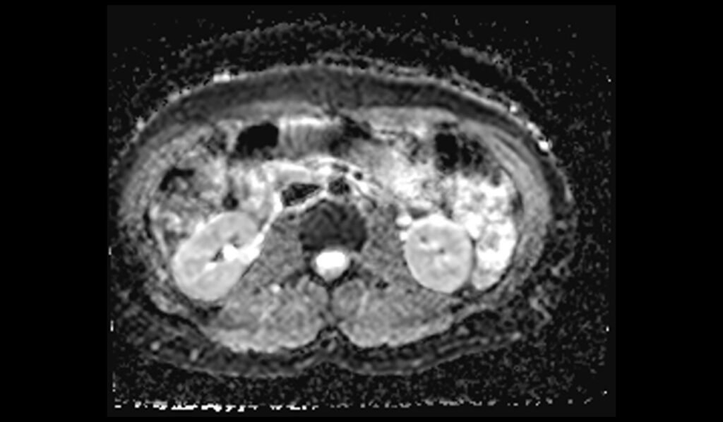 MRI kidneys DWI axial images