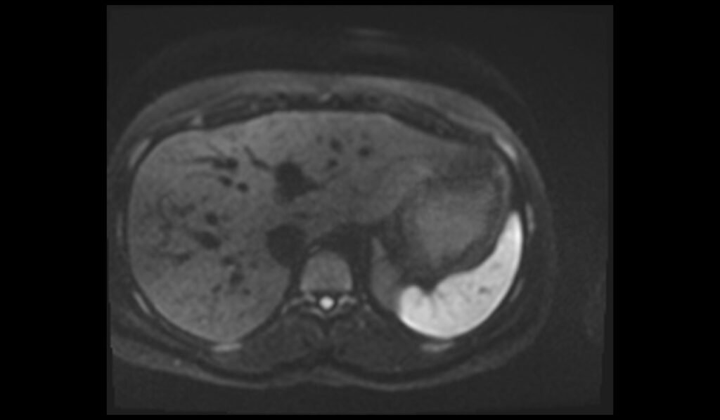 MRI kidneys DWI axial images