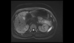 MRI kidneys DWI axial images