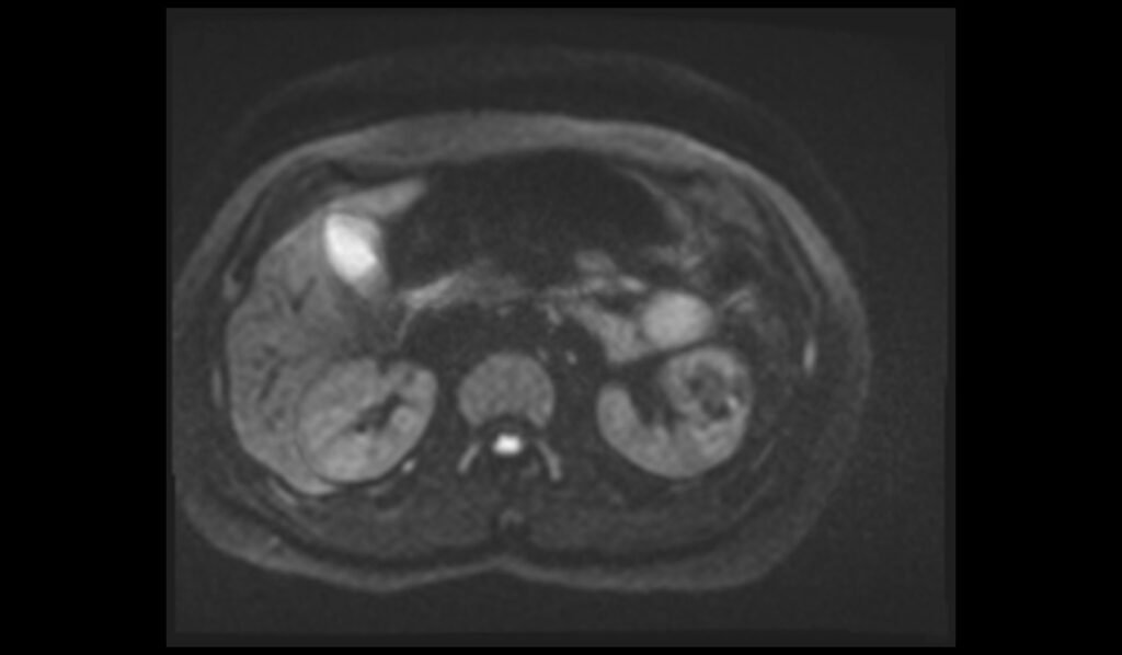MRI kidneys DWI axial images