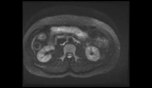 MRI kidneys DWI axial images