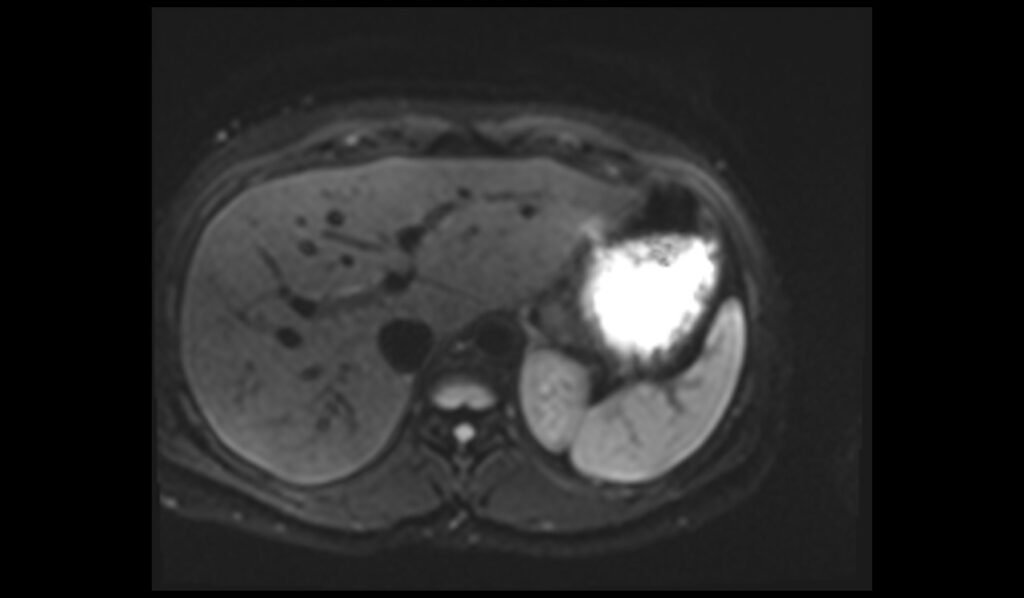 MRI kidneys DWI axial images