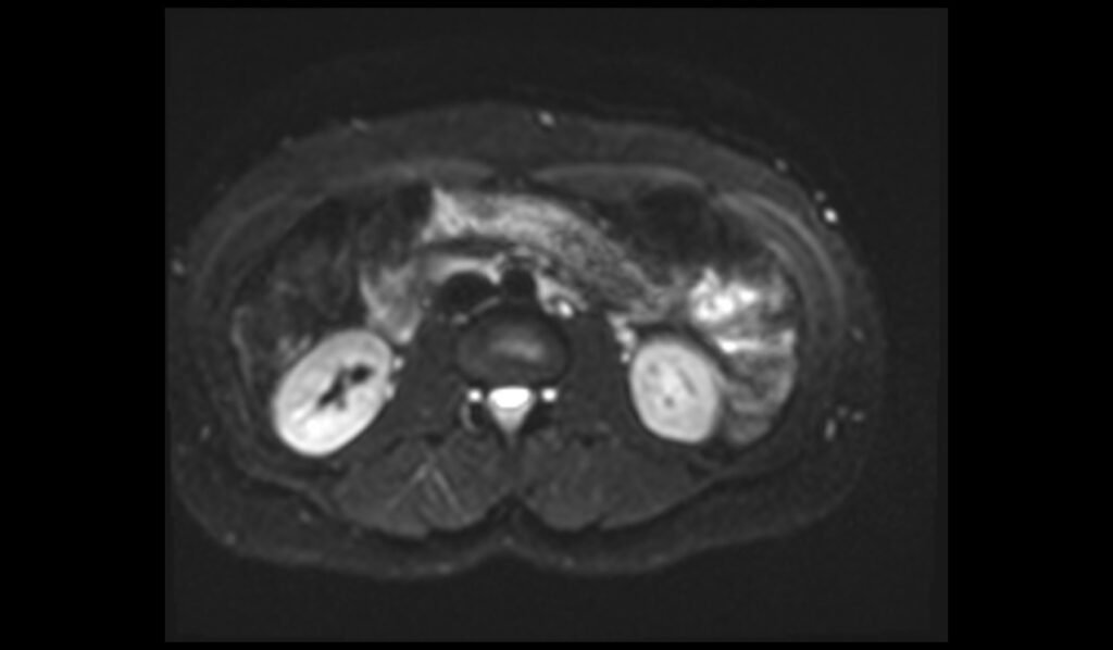 MRI kidneys DWI axial images