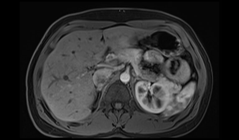 MRI kidneys post contrast T1 DIXON axial images