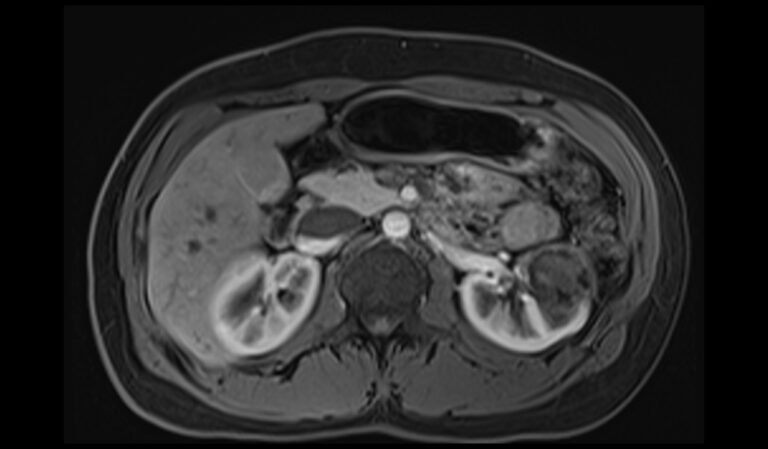 MRI kidneys post contrast T1 DIXON axial images