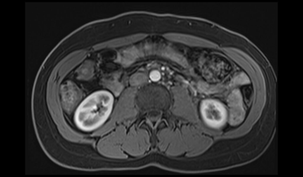 MRI kidneys post contrast T1 DIXON axial images