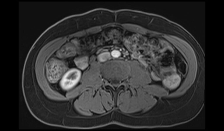 MRI kidneys post contrast T1 DIXON axial images
