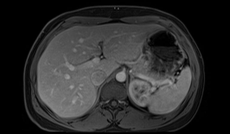 PLAN MRI KIDNEYS T1 VIBE AXIAL POST nephrographic phase - mrimaster
