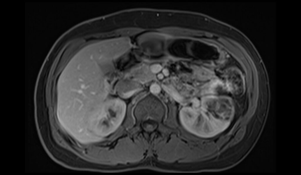 PLAN MRI KIDNEYS T1 VIBE AXIAL POST nephrographic phase - mrimaster