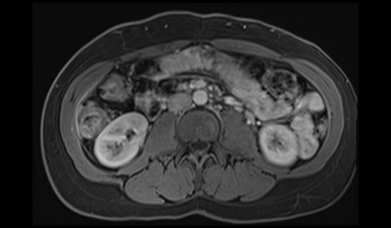 PLAN MRI KIDNEYS T1 VIBE AXIAL POST nephrographic phase - mrimaster