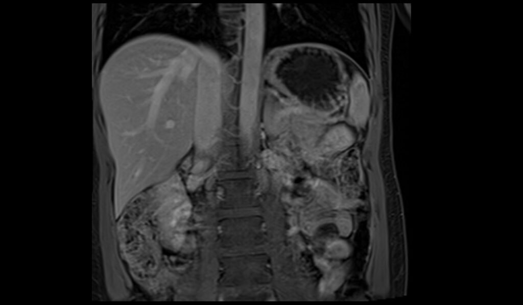 MRI kidneys post contrast T1 DIXON coronal images