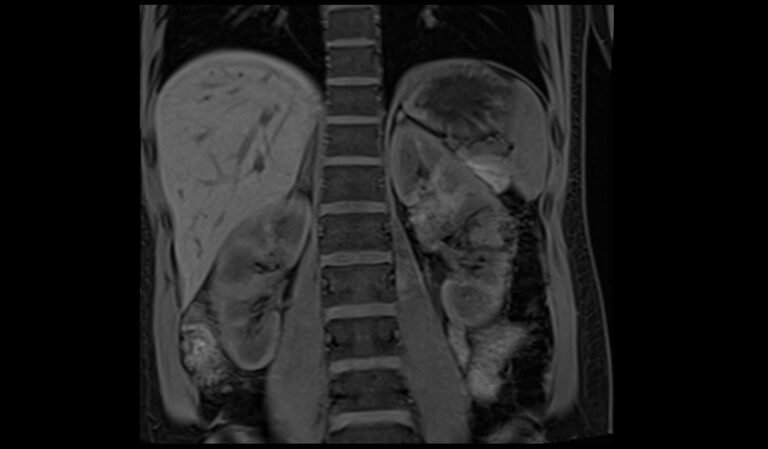 MRI kidneys T1 VIBE DIXON coronal images